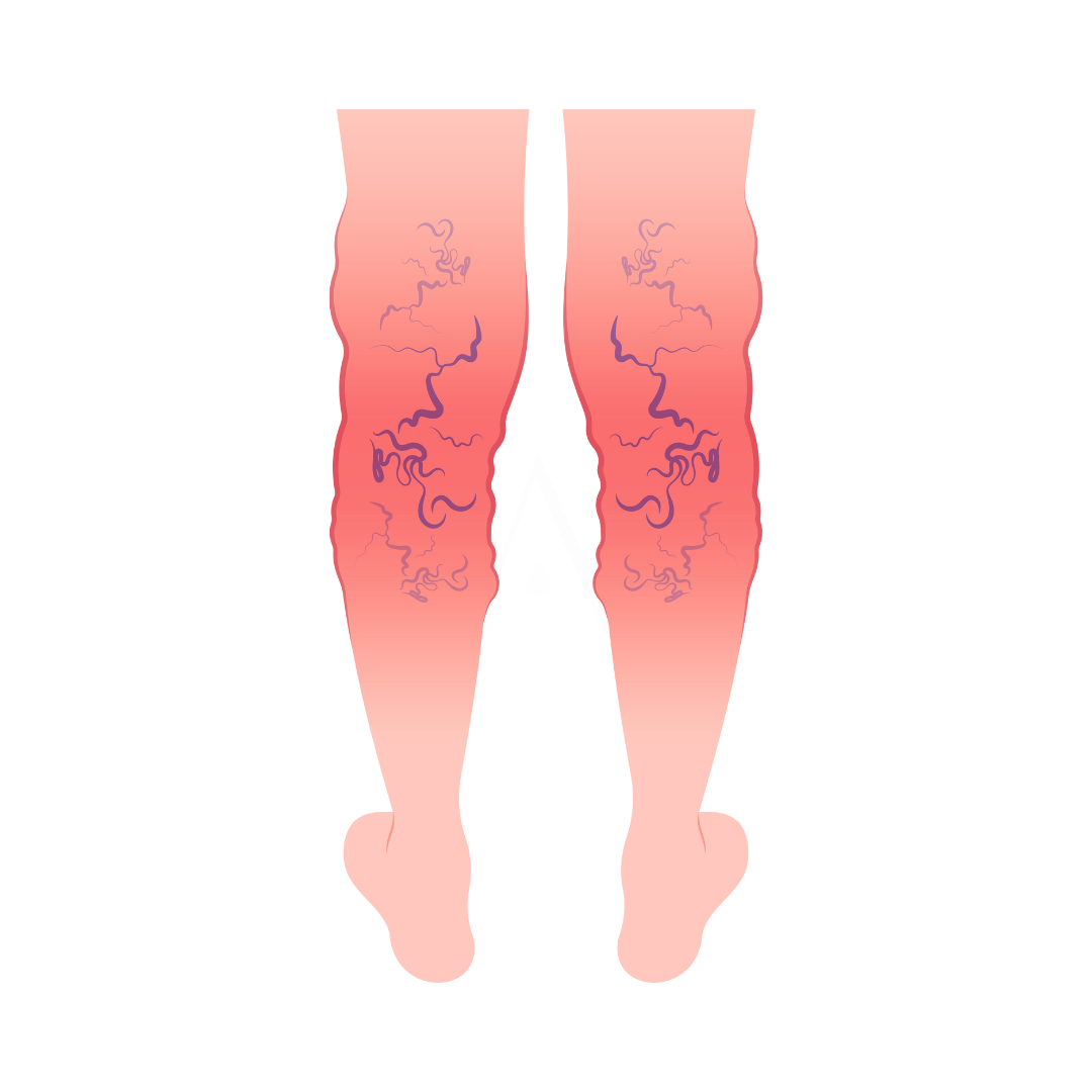 Varicose veins - body support, natural supplements and prevention