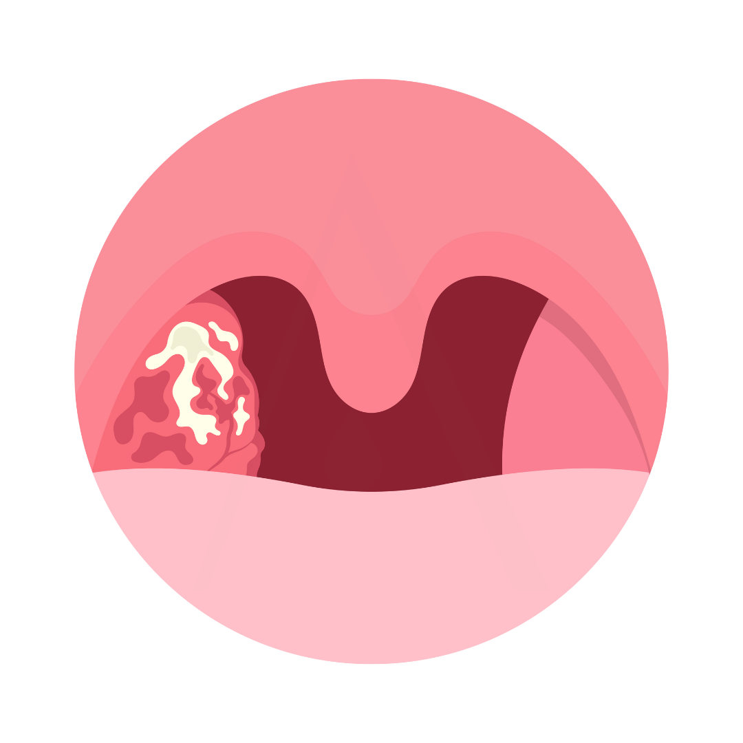 Adenoids - body support, natural supplements and prevention